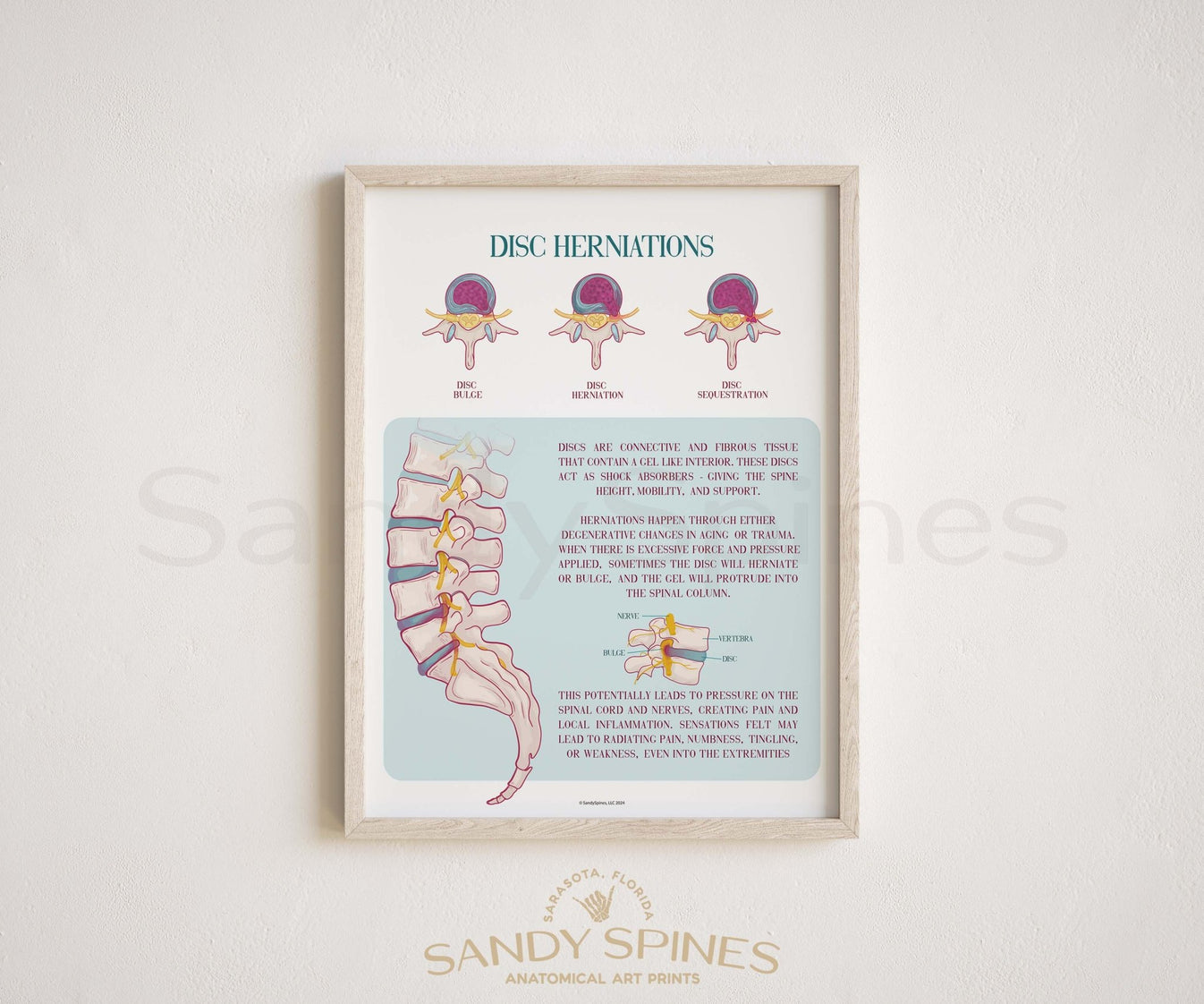 Disc Herniation Anatomy Poster for Chiropractors & PTs – SandySpines