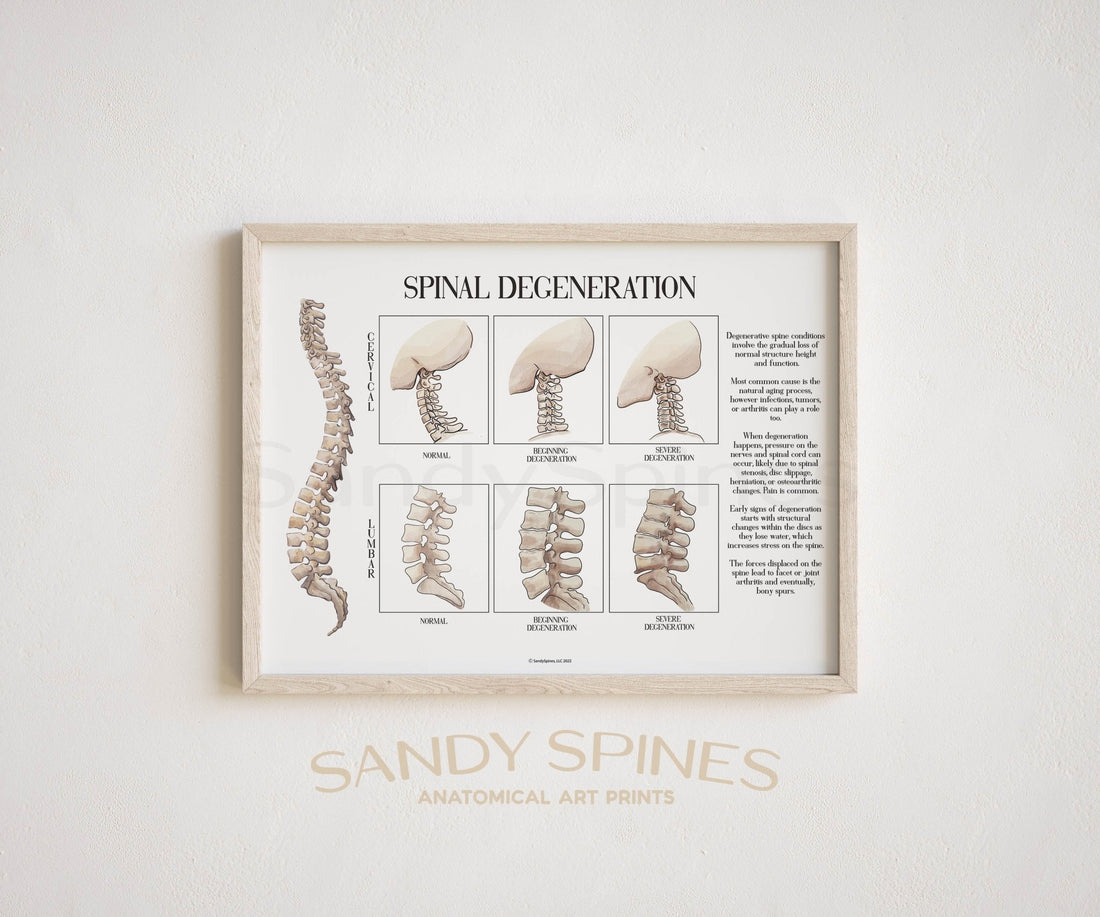 Spinal Degeneration | Posters for Chiropractors and PTs – SandySpines